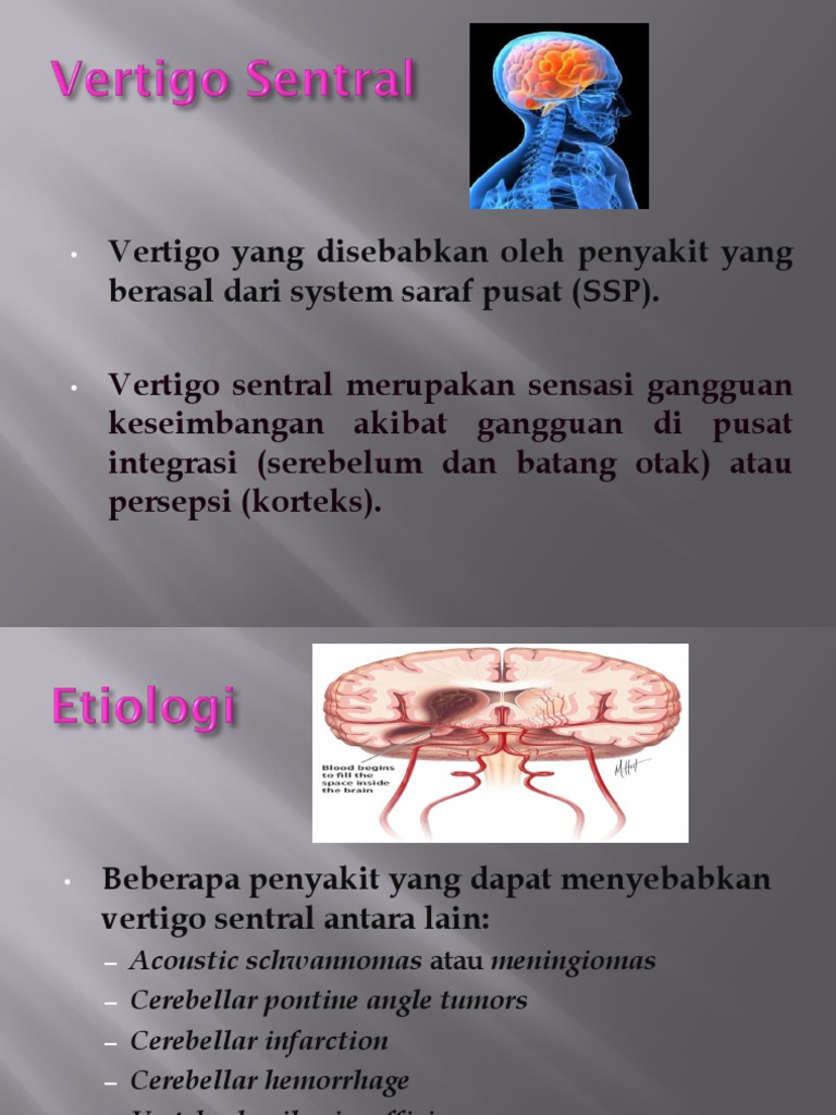 Vertigo Sentral: Gejala dan Diagnosis | PDF