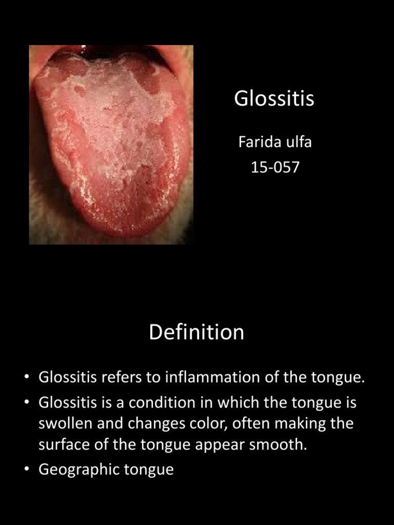 Glossitis: Farida Ulfa 15-057 | PDF | Rtt | Immunology