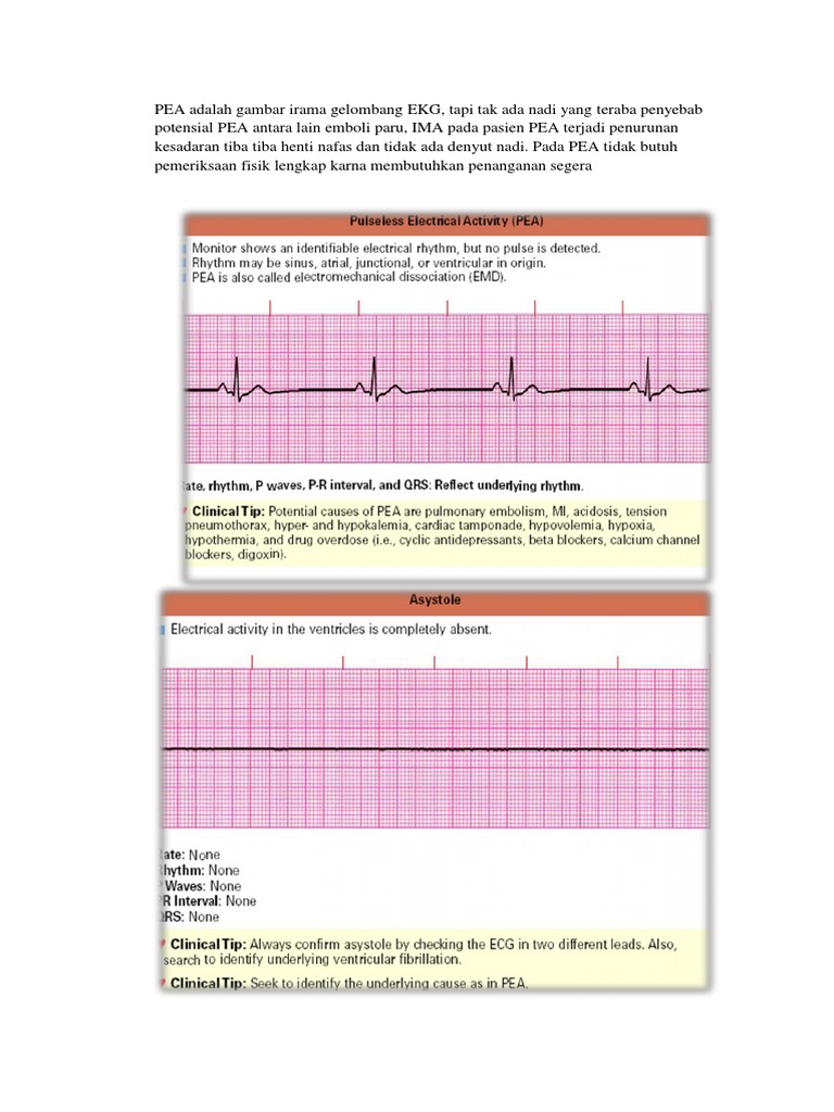 PEA Adalah Gambar Irama Gelombang EKG | PDF