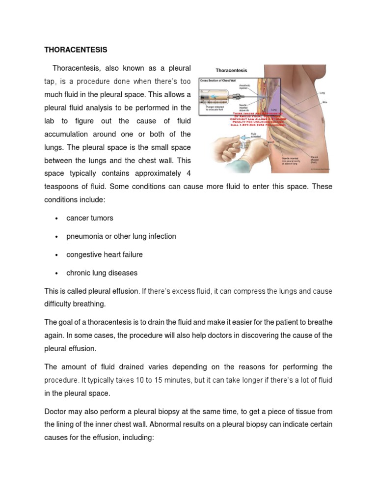 Thoracentesis Procedure Steps
