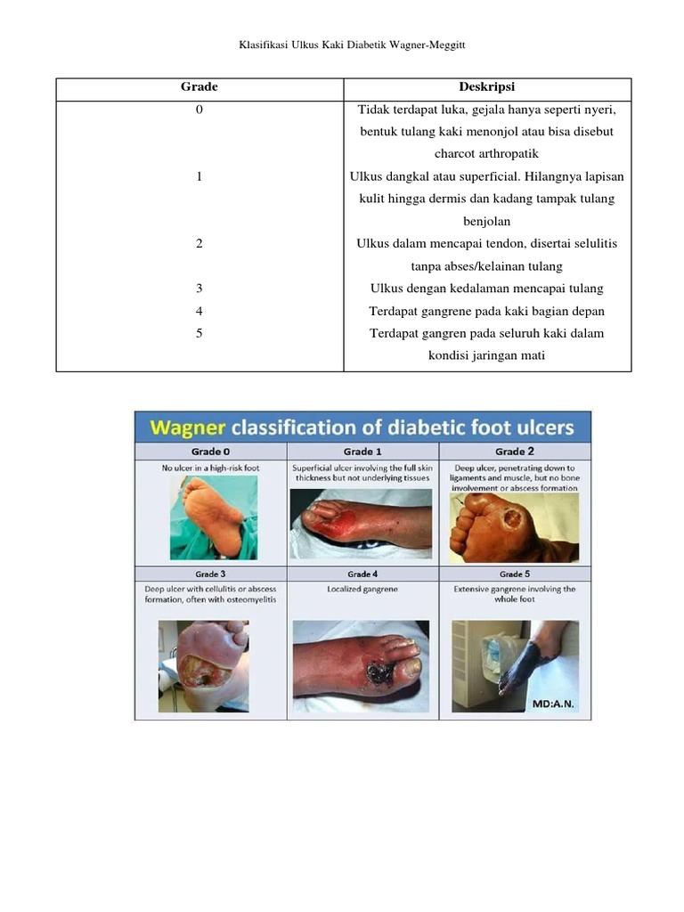 Klasifikasi Ulkus Kaki Diabetik Wagner