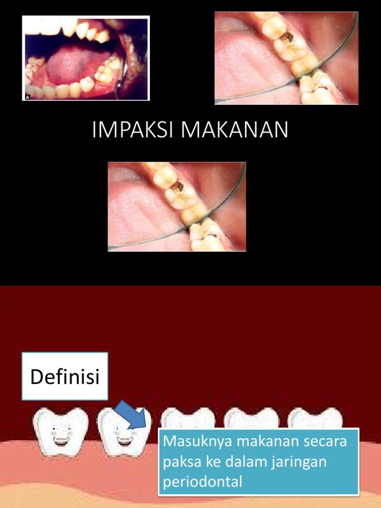 Kelompok 3 Impaksi Makanan | PDF