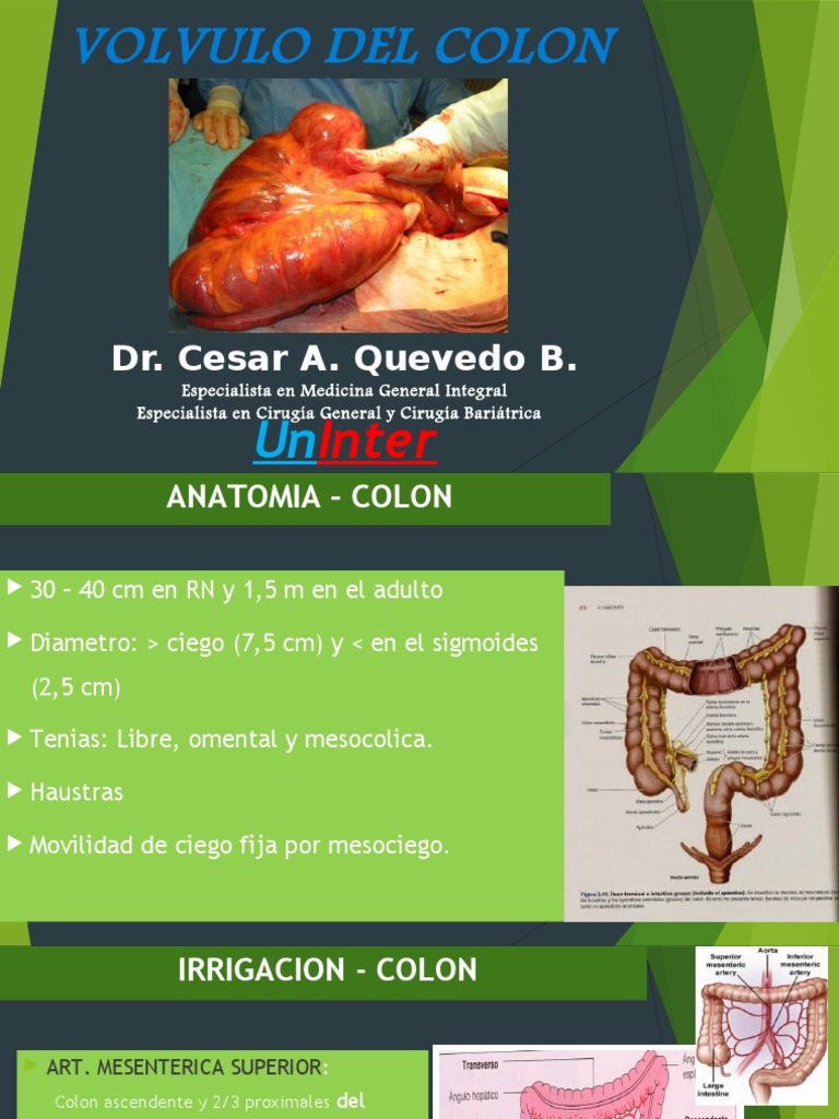 Volvulo Del Colon Dr. Cesar Quevedo | PDF | Intestino grueso | Cáncer ...