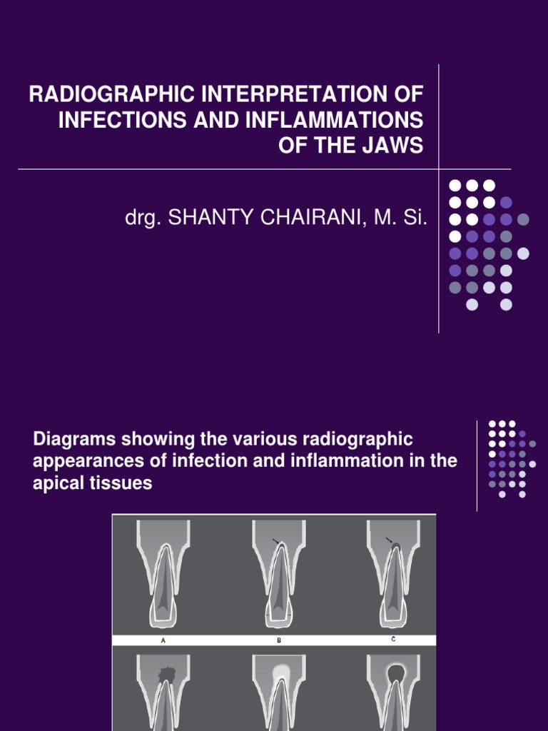 INFECTION OF THE JAW.pptx | Dentistry | Medical Specialties