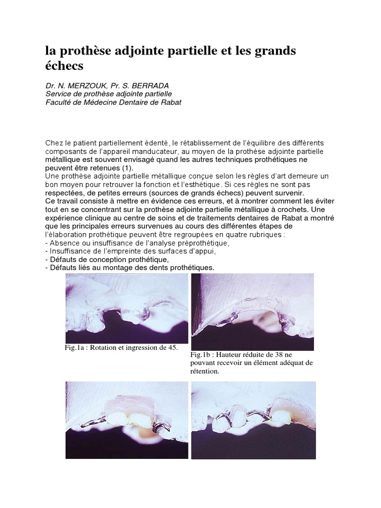 La Prothèse Adjointe Partielle Et Les Grands Échecs | PDF | Dentiers | Anatomie dentaire