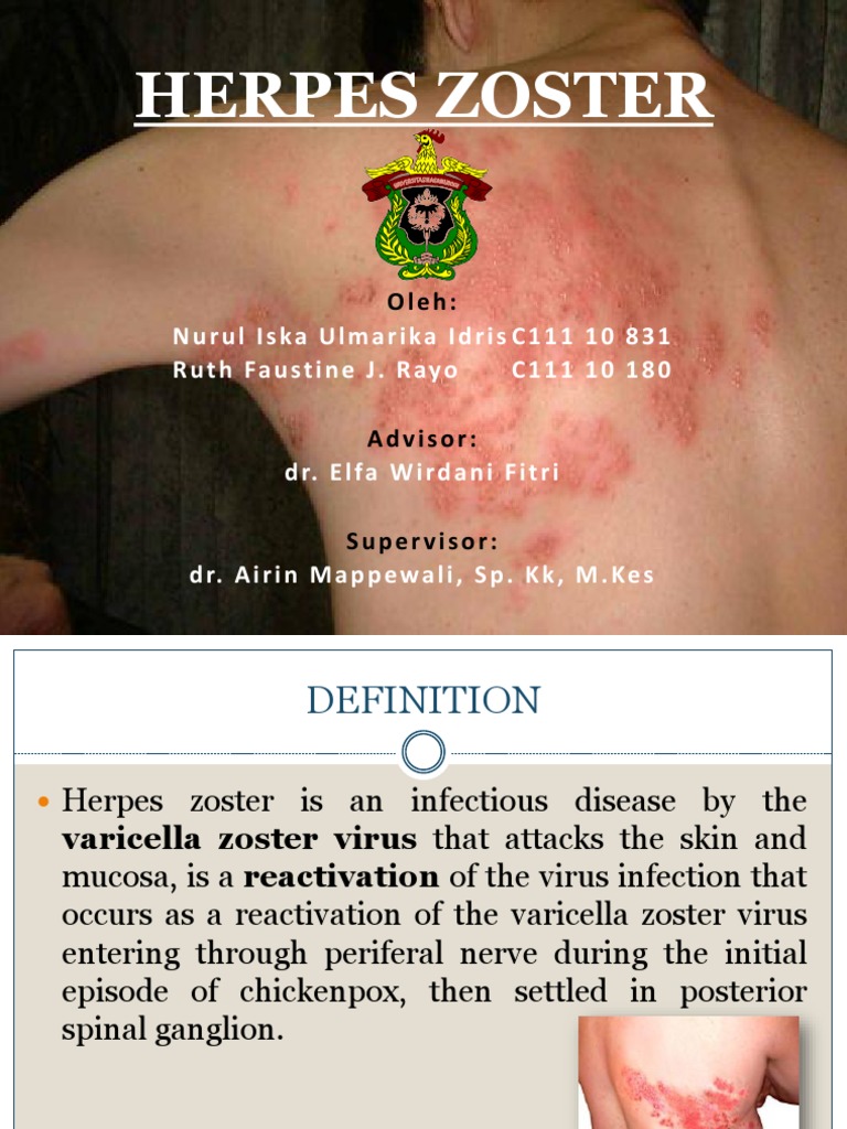 Herpes Zoster: Nurul Iska Ulmarika Idrisc111 10 831 Ruth Faustine J ...