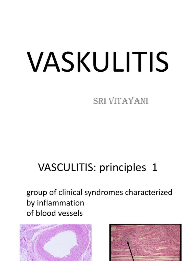 Understanding Vasculitis: Types and Treatment | PDF | Blood Vessel ...