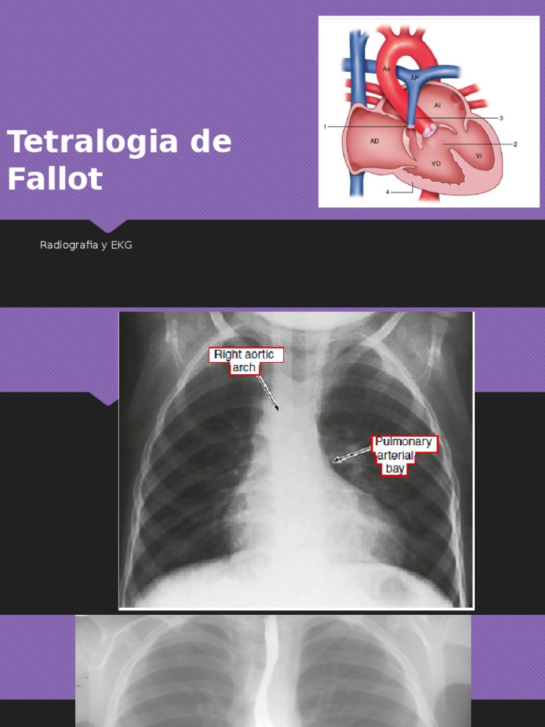 Radiografía y EKG en Tetralogía de Fallot | PDF