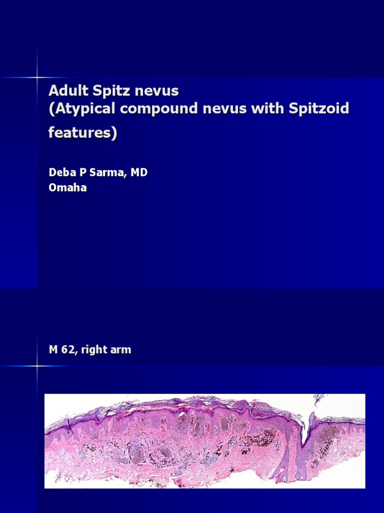 Adult Spitz Nevus (Atypical Compound Nevus With Spitzoid Features), M ...