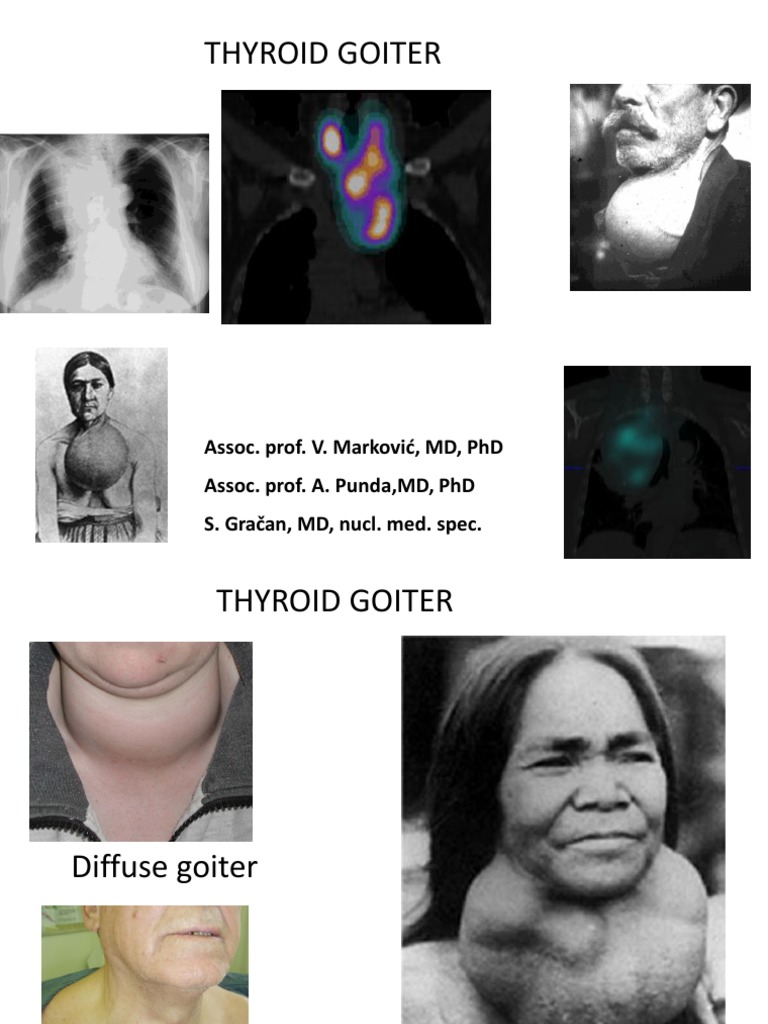 Thyroid Goiter | PDF | Thyroid | Clinical Medicine