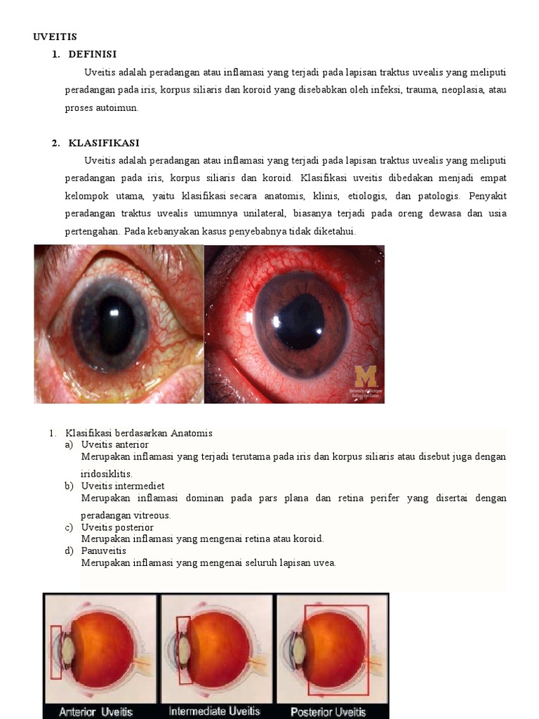 Klasifikasi dan Etiologi Uveitis | PDF