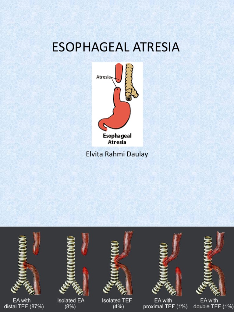 Esophageal Atresia: Elvita Rahmi Daulay | PDF | Esophagus | Anatomy