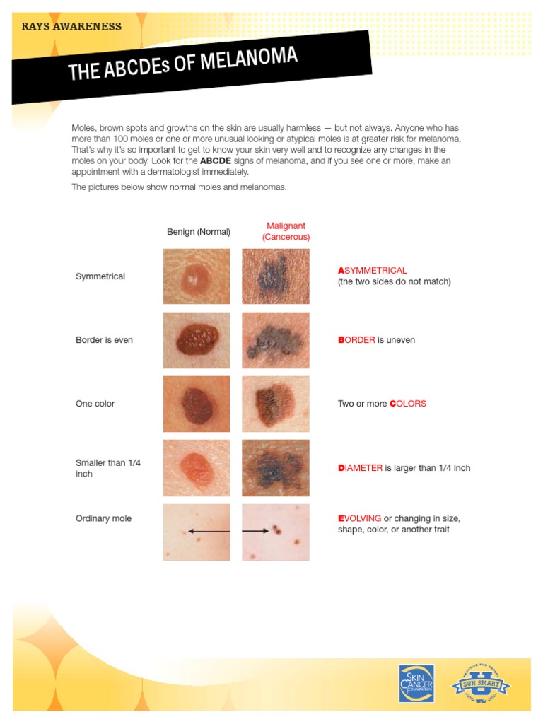 The Abcdes of Melanoma: Rays Awareness | PDF