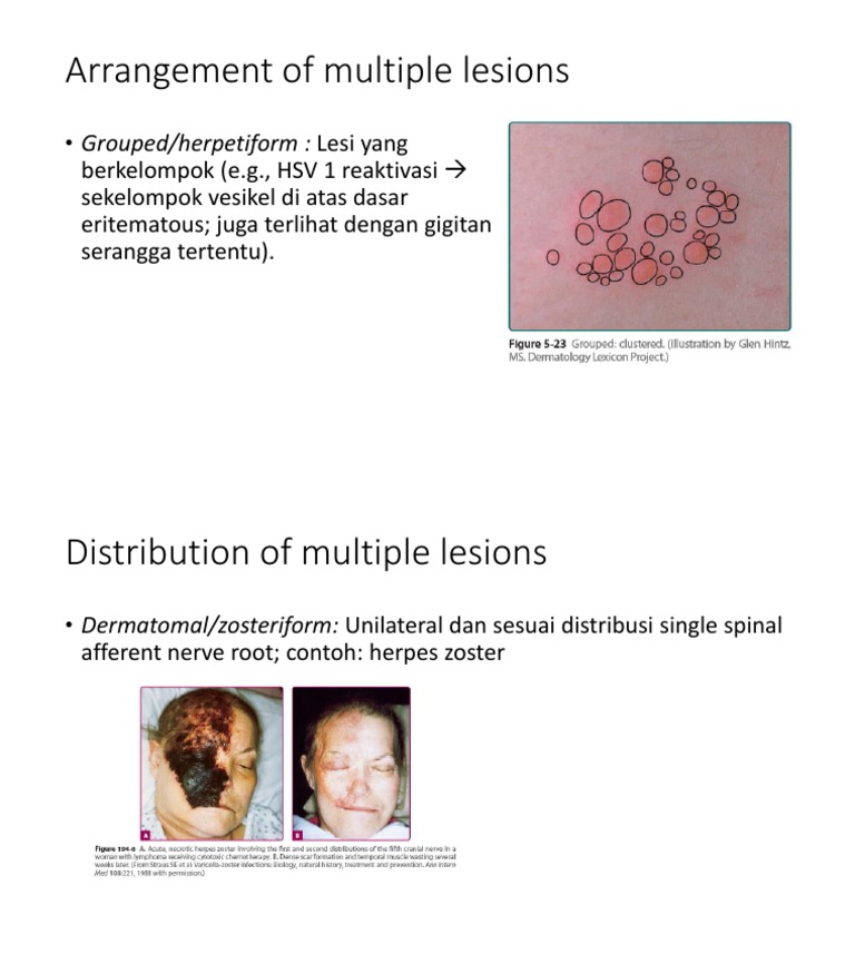 PR Herpetiform Zosteriform | PDF