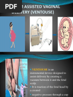 Performing MVA Using The Ipas | PDF | Uterus | Medical Specialties
