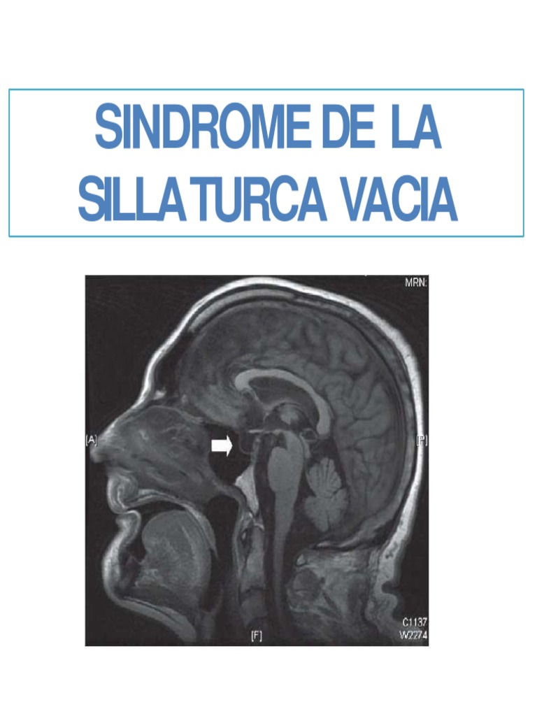 Sindrome de La Silla Turca Vacia | Hormona | Sistema endocrino