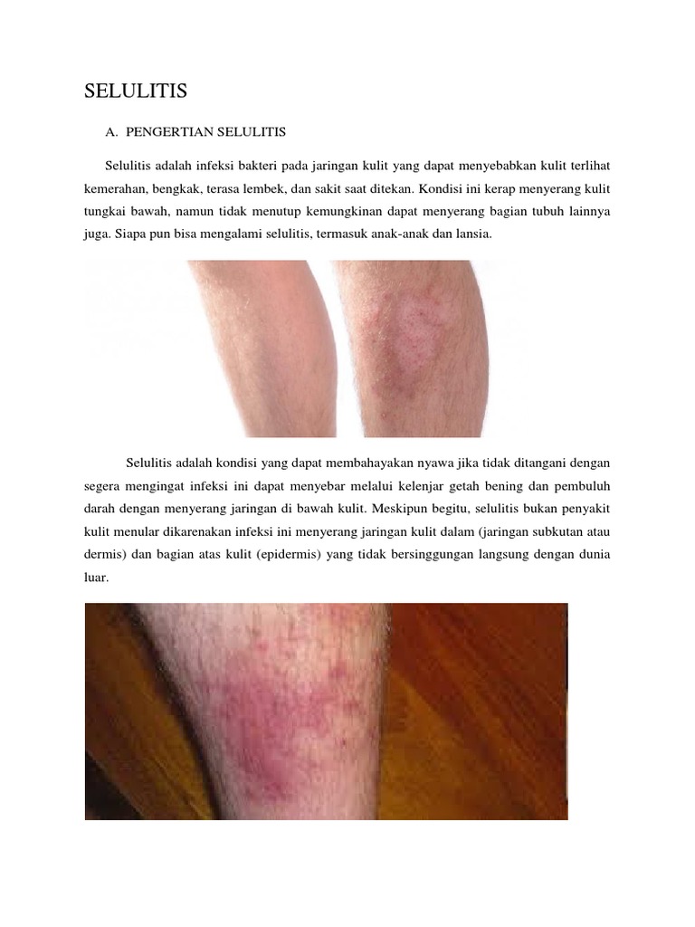 Unapengertian Selulitis | PDF