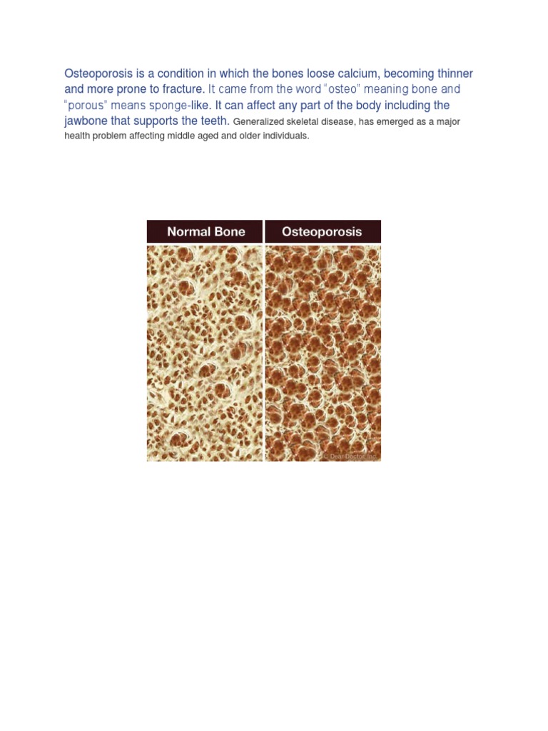 Understanding Osteoporosis: A Condition of Thinning, Porous Bones That ...