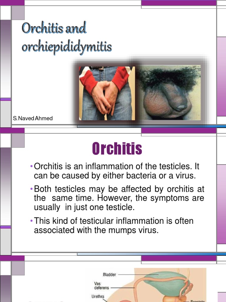 Orchitis 160406115741 | PDF | Male Genital Disorders | Epidemiology