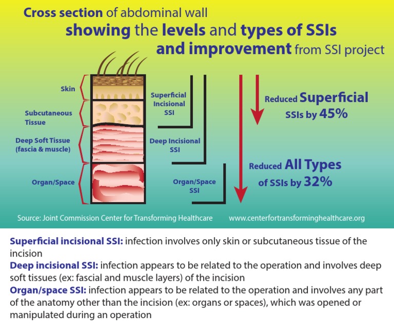 SSI Abdominal Wall Infographic PDF | PDF