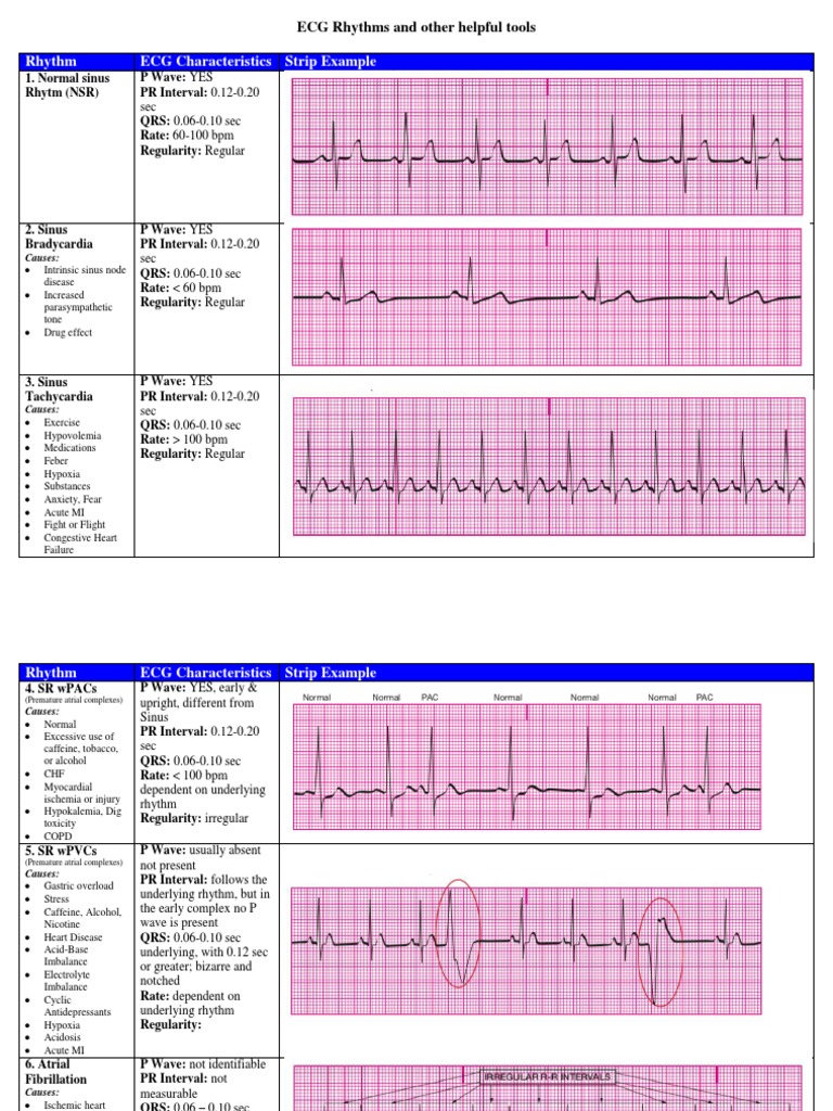 Rhythm ECG Characteristics Strip Example: ECG Rhythms and Other Helpful ...