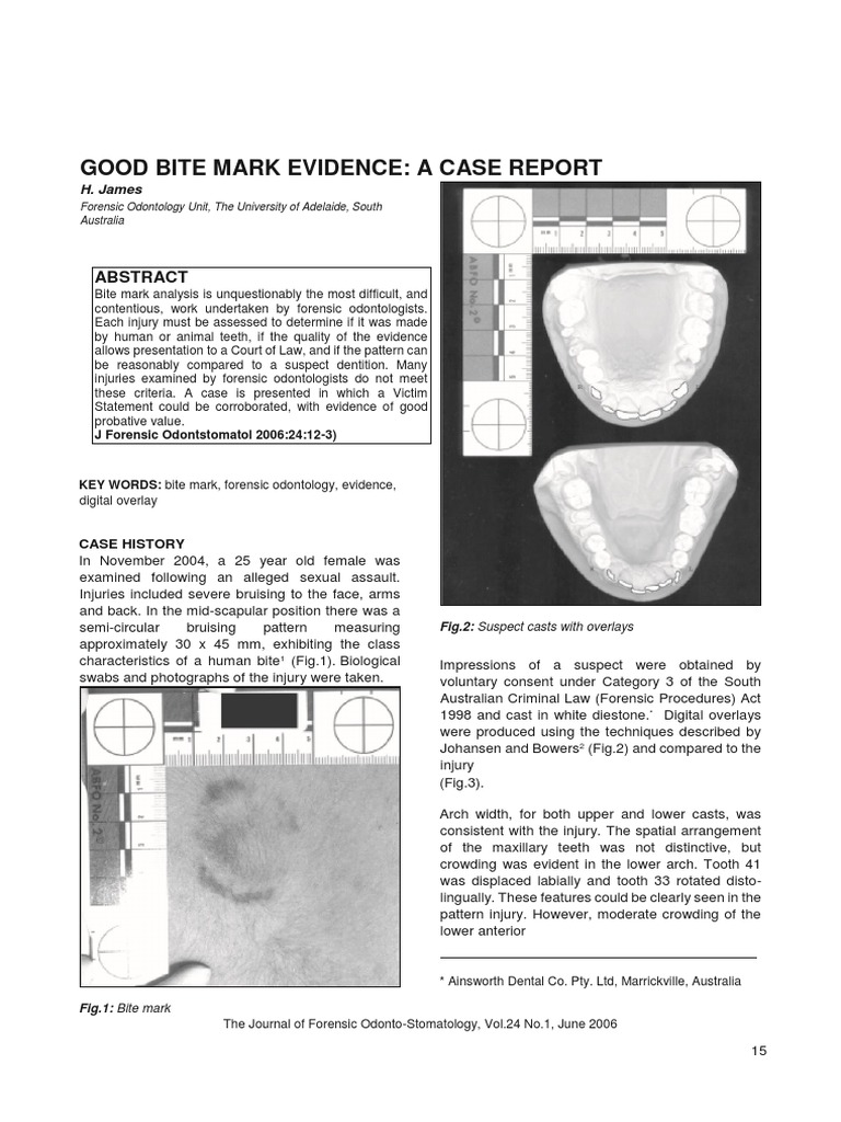 Good Bite Mark Evidence: A Case Report: H. James | Download Free PDF ...