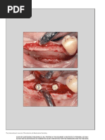 Straumann® Guided Surgery | PDF | Dental Implant | Surgery