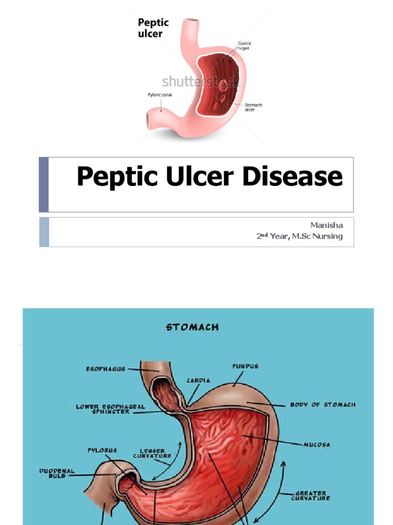 Peptic Ulcer Disease: Manisha 2 Year, M.SC Nursing | PDF | Stomach ...