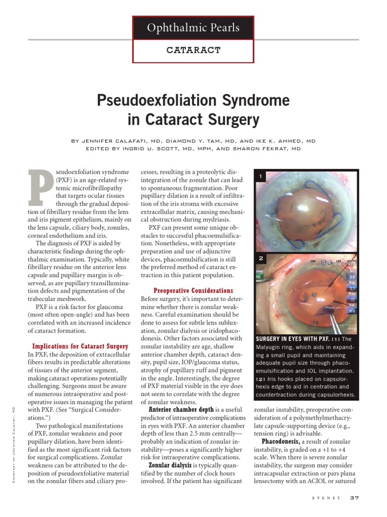 Pseudoexfoliation Syndrome in Cataract Surgery: Ophthalmic Pearls | PDF | Ophthalmology | Vision