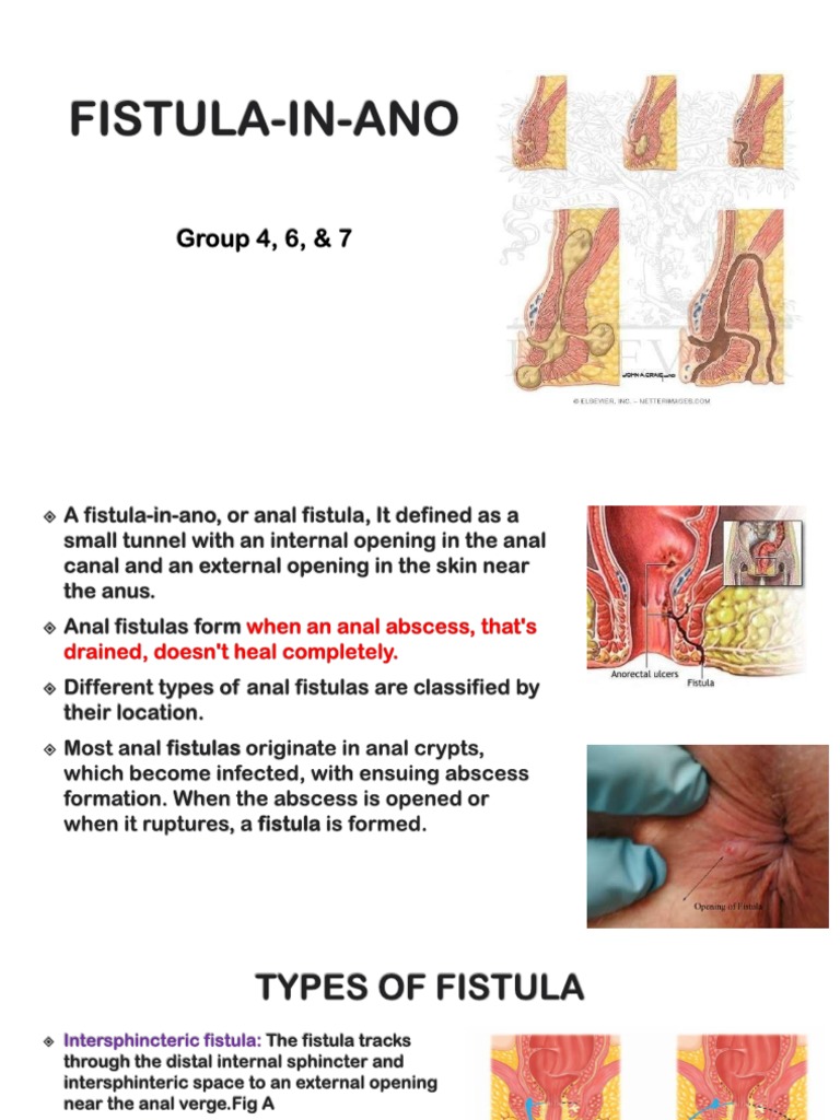 Fistula in Ano | PDF | Digestive Diseases | Epidemiology