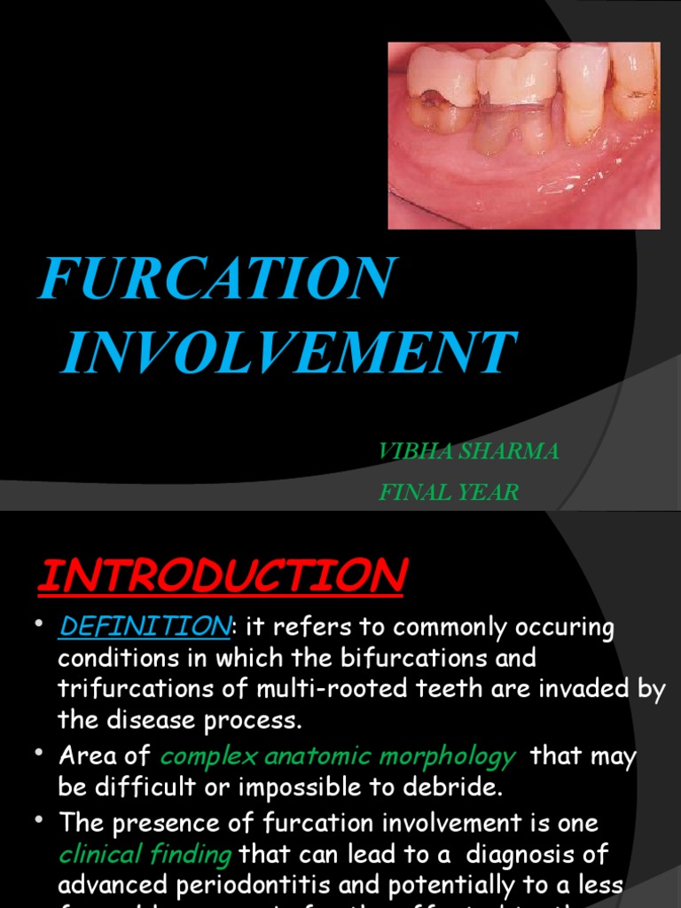 Understanding Furcation Involvement | PDF | Periodontology | Medical ...