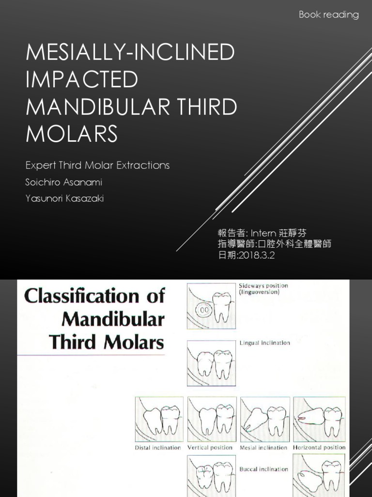 Mesially-Inclined Impacted Third Molars | PDF