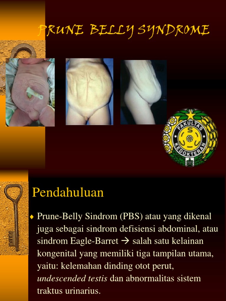 Prune Belly Syndrome | PDF