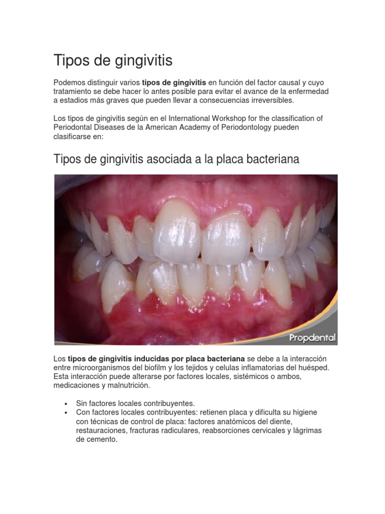 Clasificación de tipos de gingivitis | PDF | Enfermedades y trastornos ...