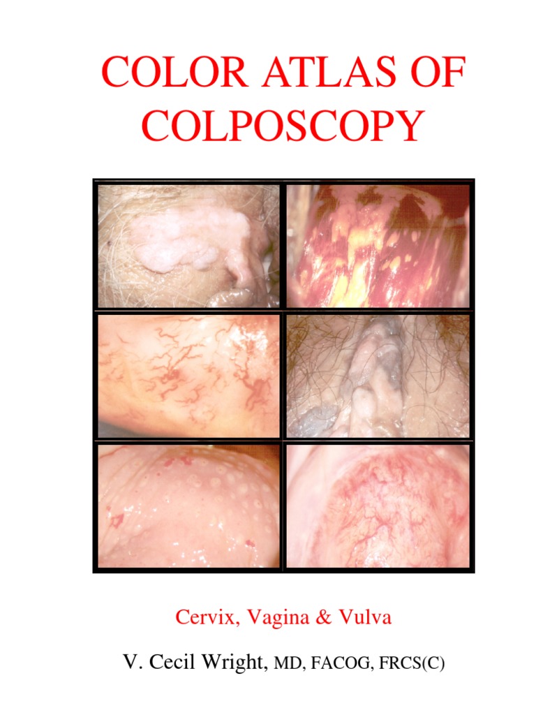 Atlas de Colposopia PDF | PDF | Medical Specialties | Anatomy