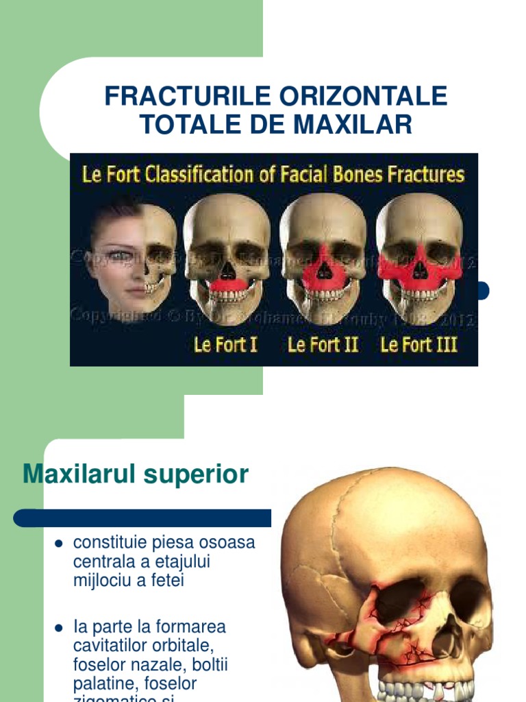 Fracturi | PDF
