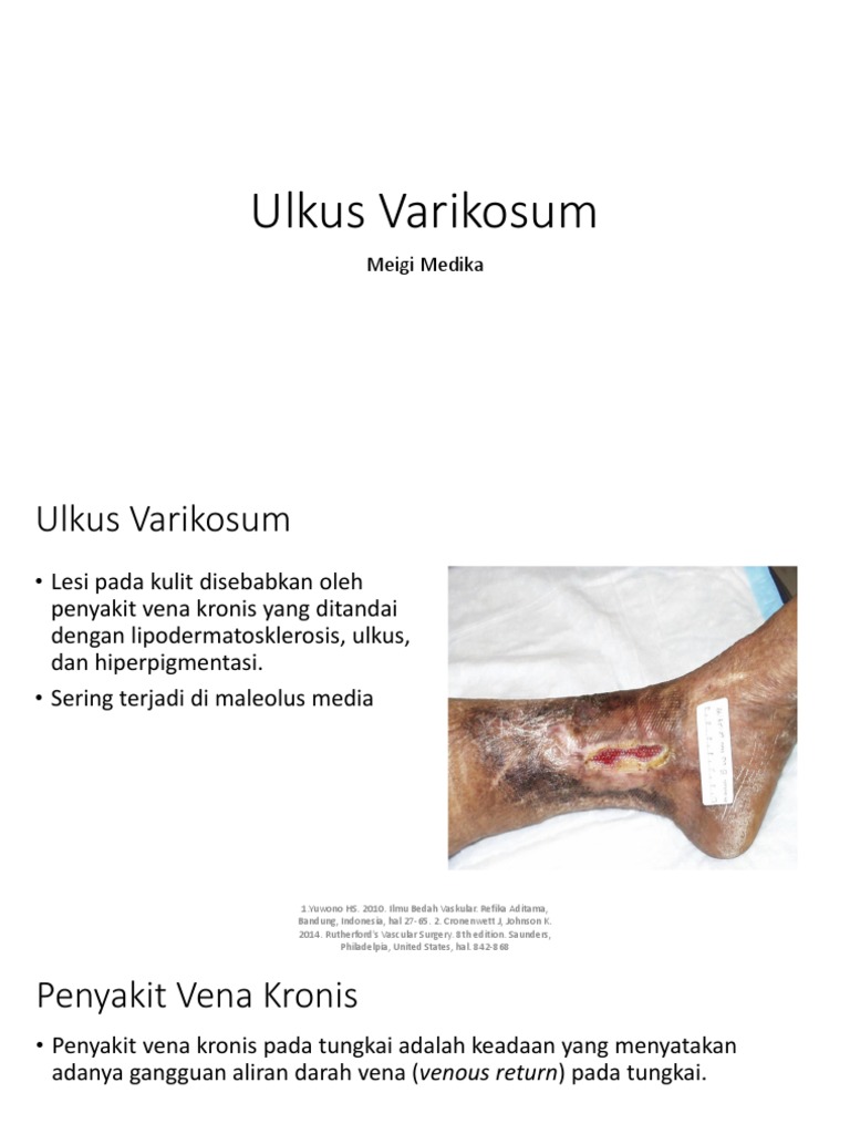 Penanganan Ulkus Varikosum pada Tungkai | PDF