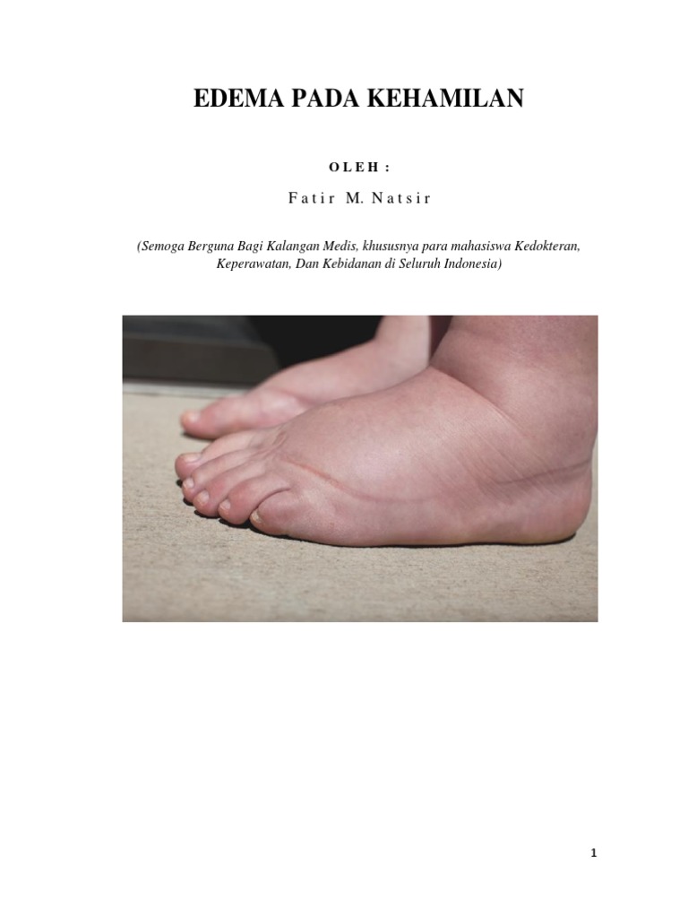 Edema Pada Kehamilan | PDF