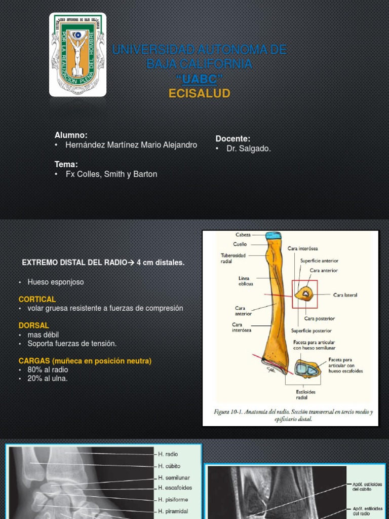 FX Colles, Smith y Barton | PDF | Traumatologia | Hueso