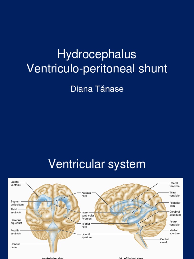 VP Shunt | PDF | Cerebrospinal Fluid | Human Anatomy