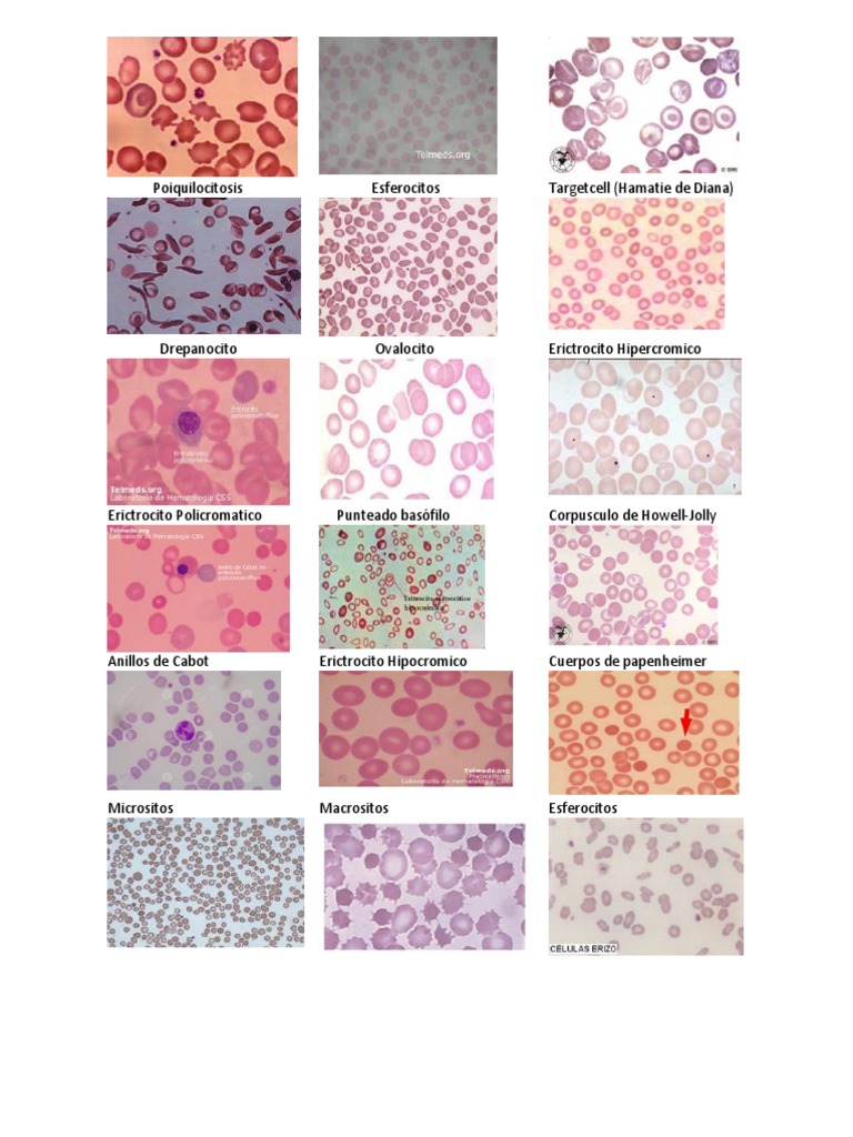 Poiquilocitosis.docx
