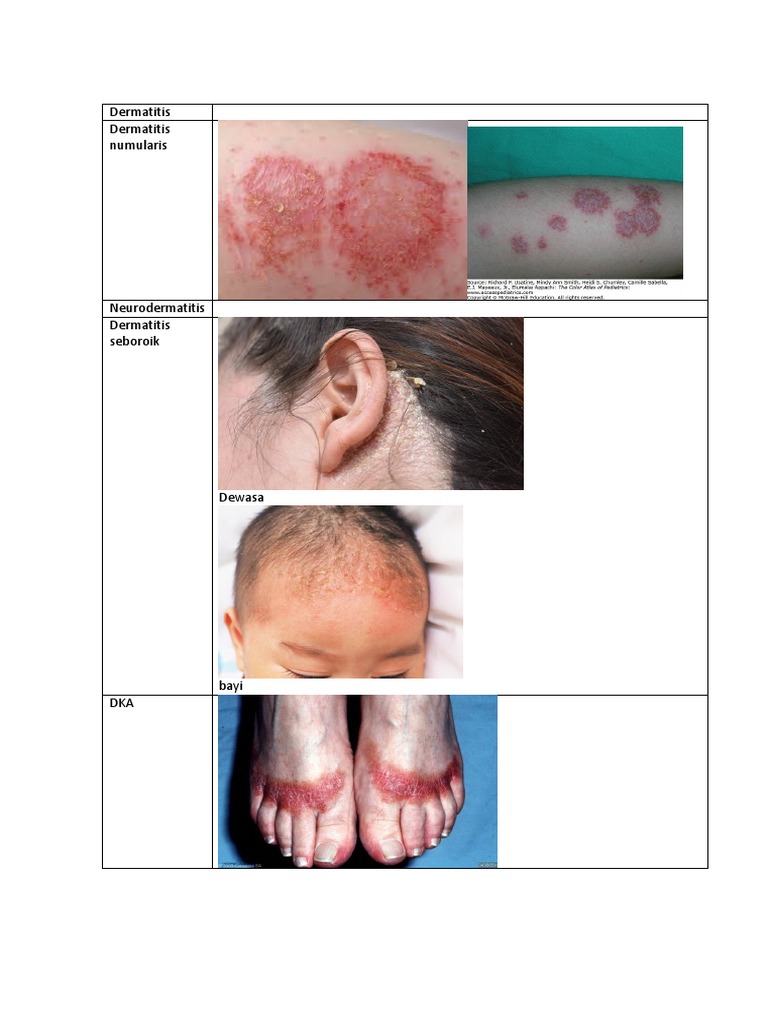 Gambar 2 | PDF | Dermatitis | Autoimmune Disease