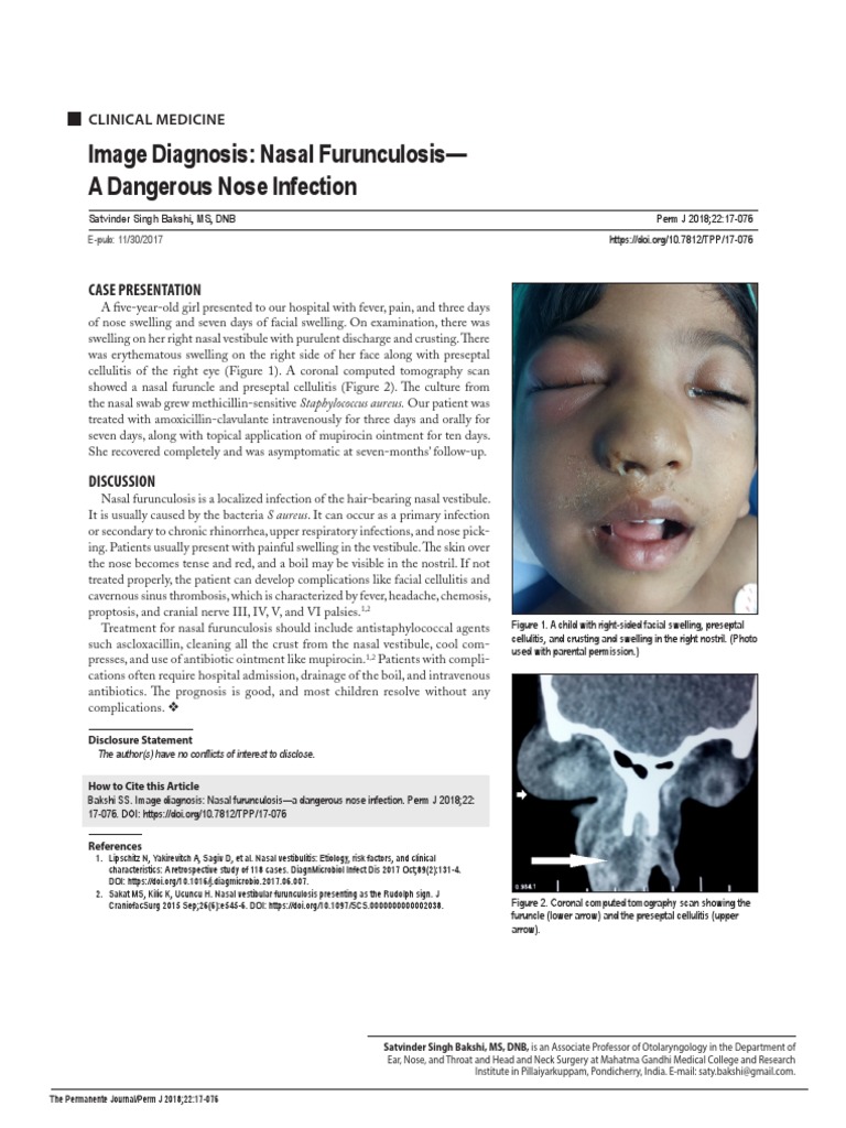 Vestibulitis | PDF | Diseases And Disorders | Clinical Medicine
