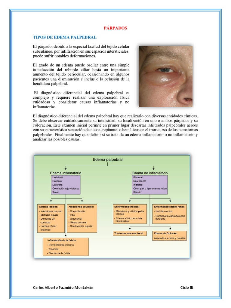Edema Palpebral y Blefaritis | PDF | Edema | Inflamación