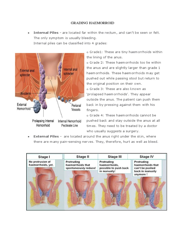 Grading Haemorroid | PDF