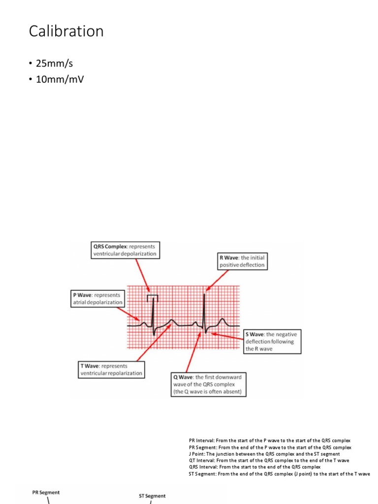 An ECG Interpretation Guide Detailing Key Waveforms, Intervals, and ...