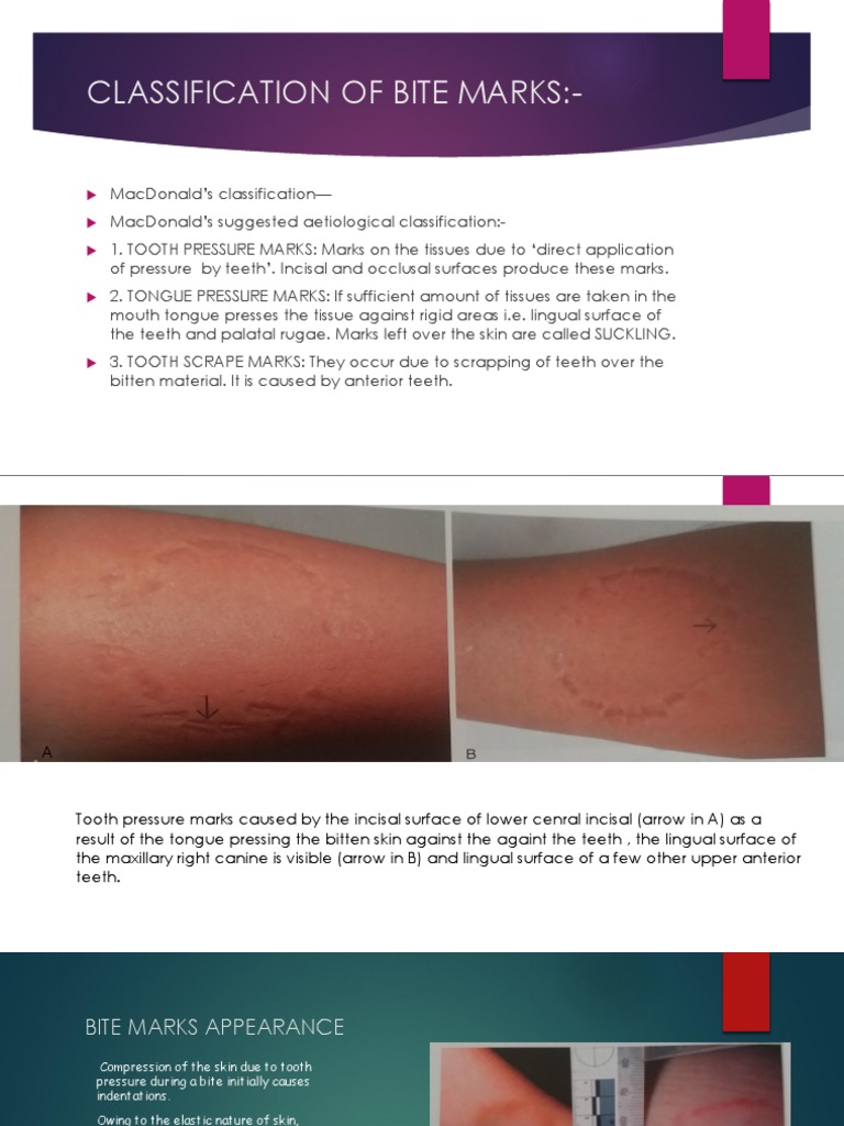 Classification of Bite Marks | PDF | Tooth | Human Anatomy