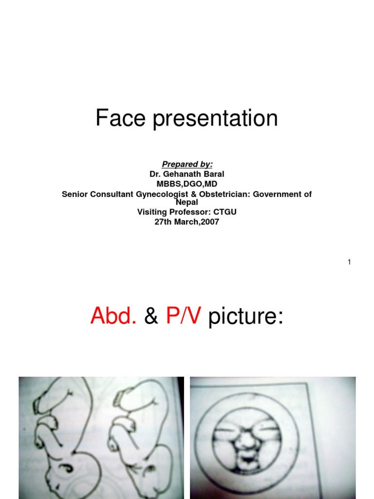 Face Presentation in Obstetrics | PDF | Self-Improvement | Wellness