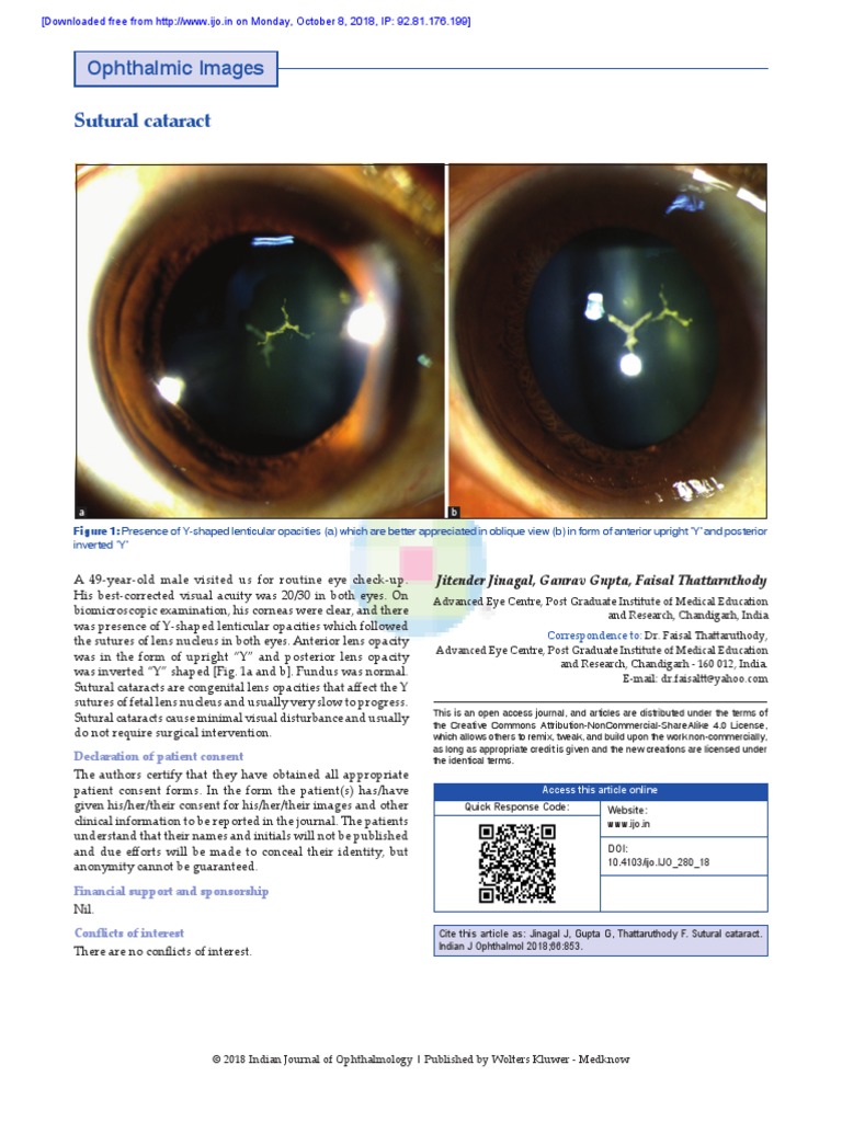 Sutural Cataract Ophthalmic Images | PDF | Cataract | Ophthalmology