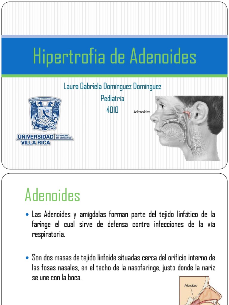 Hipertrofia de Adenoides: Laura Gabriela Domínguez Domínguez Pediatría ...